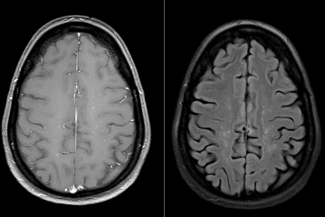 CLIPPERS - Chronic lymphocytic inflammation with pontine perivascular ...