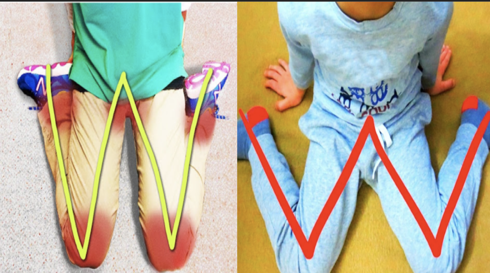 The Negative Effects Of “W” Sitting: Never Let Your Kids Sit In a “W ...