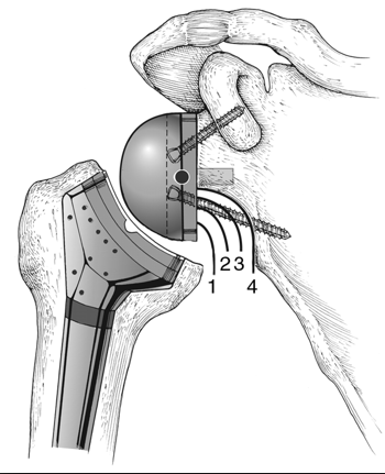 UW Shoulder and Elbow Academy: Scapular notching in reverse shoulder ...
