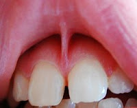 Frenectomy