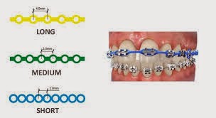 AKU DIA DAN LAGU: braces ~ part IV ~ pemasangan braces