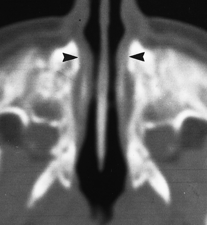 Sweet Bella Michelle: Breaking It Down: What Is Congenital Nasal ...
