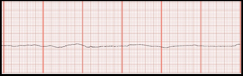 Practice EKG Rhythm Strips 141