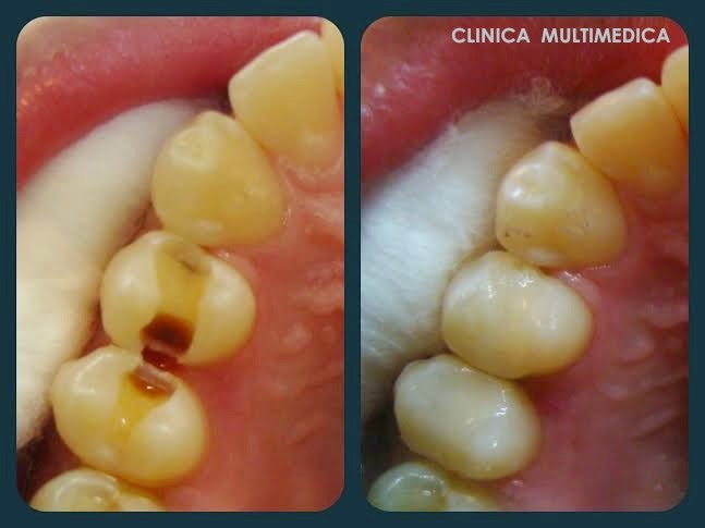 Odontología - Elsa & Asociados: CARIES INTERPROXIMALES