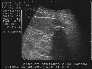 imagini splina Calcefiere splenica ecografie | Terapii naturiste si ...