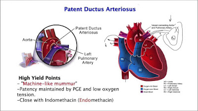 dr.Lestari Rahmah, MKT: PATENT DUCTUS ARTERIOSUS