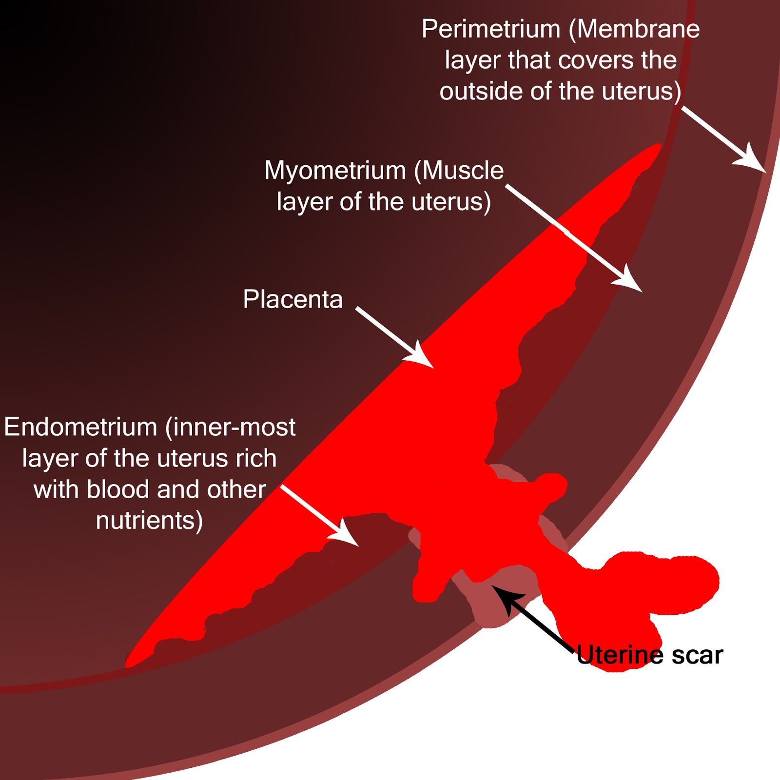 The Accreta Survivor: What exactly is placenta accreta??? (part 2 of 2)