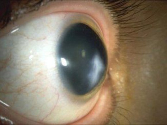 Images For Keratoconus ~ YOUNG DOCTORS' RESEARCH FORUM