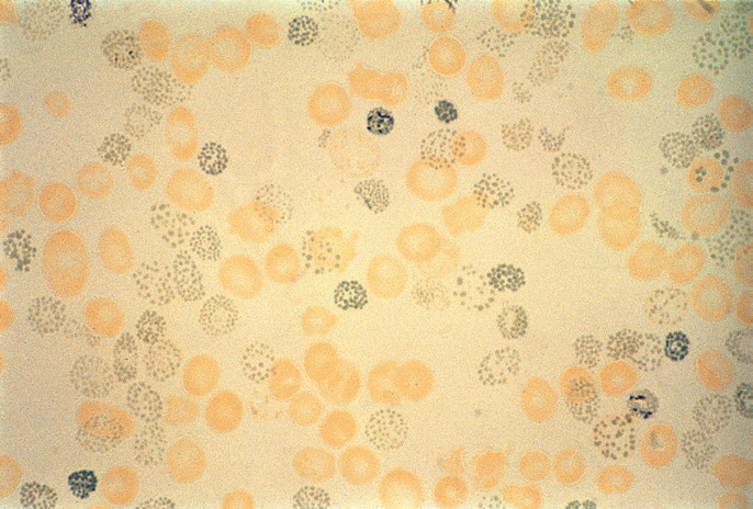 VETERINARY HEMATOLOGY DEXTERVET: Blood film from a patient with ...