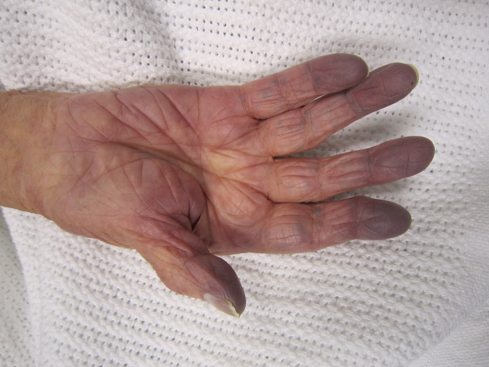 Approach to a patient with cyanosis - Dr VIVEK's blog