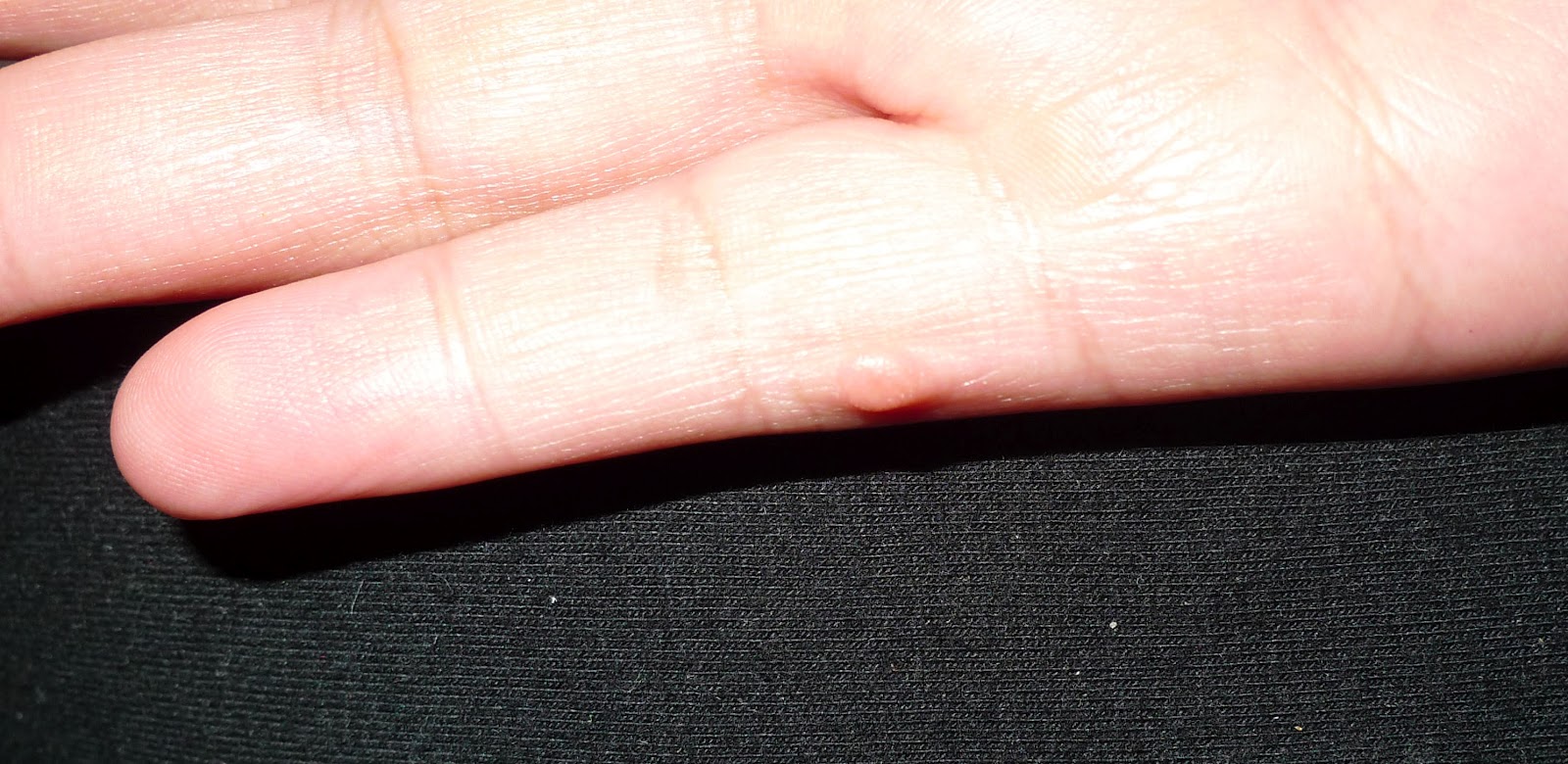 Simple Extra Digits Congenital Hand And Arm Differences Simple Extra Digits Congenital Hand And Arm Differences