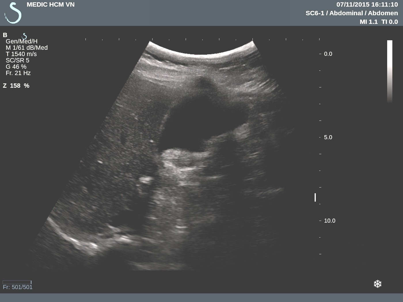 Lesser Sac Ultrasound
