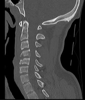Medicowesome: Flexion Tear Drop Fracture