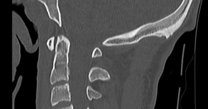 Medicowesome: Flexion Tear Drop Fracture