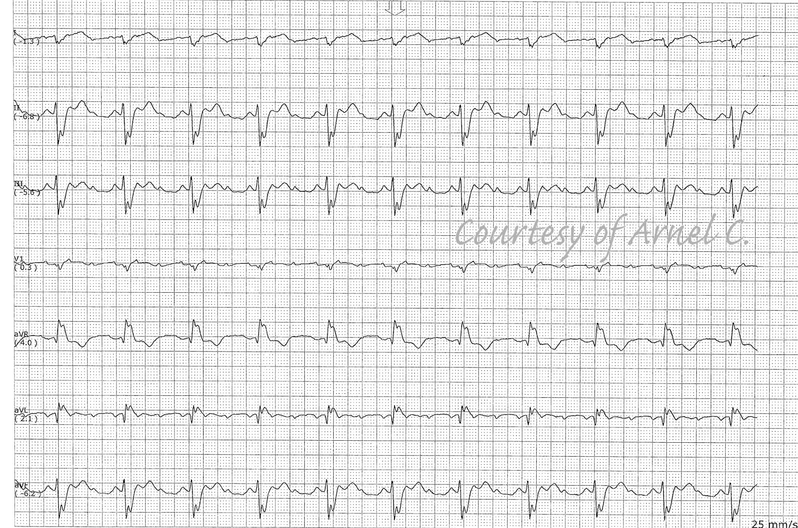 ECG Rhythms: VT or SVT (with aberrancy or fixed BB)?