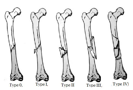 OurMedicalNotes: Winquist Classification (Degree of Comminution)