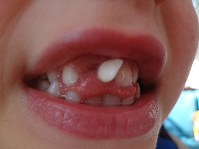 Prairie Garden: Third tooth