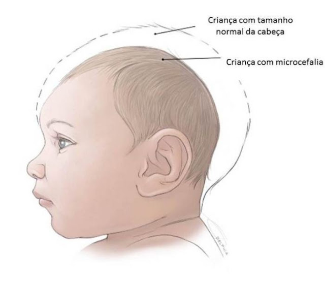 Entenda o que é a microcefalia e por que há um aumento dos casos em ...