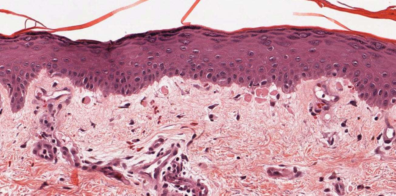 Dermoscopy Made Simple: LPLK