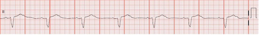 EKG Rhythm Strips 10
