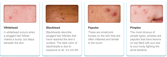 She Who Entangles...: Types of Acne