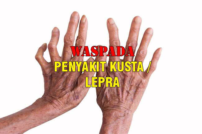 MOMENT INFINITY: Terapi Kusta dengan Produk Moment