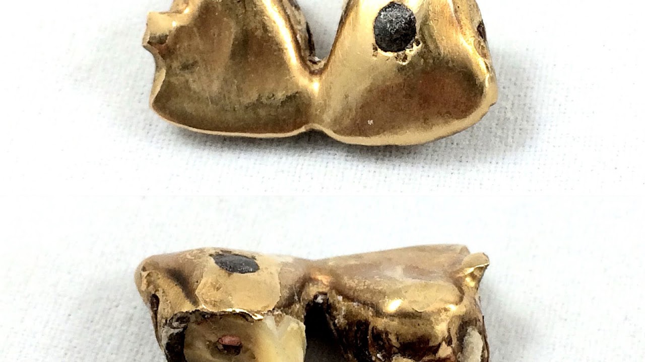Selling Dental Gold - Gold Choices
