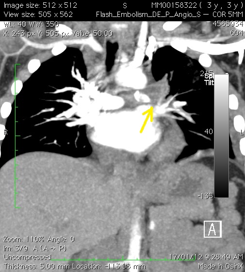 Pulmonary Embolism-CTPA - Sumer's Radiology Blog