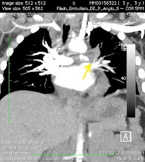 Pulmonary Embolism-CTPA - Sumer's Radiology Blog