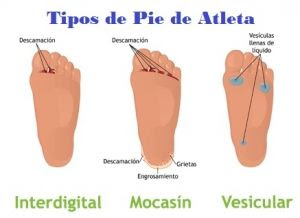 Formas de presentación del pie de atleta