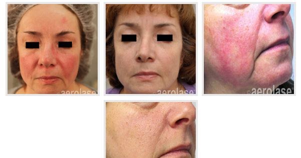 Rosacea | My Family Practice Associates