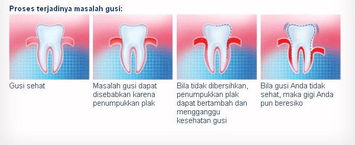 Pentingnya menjaga kesehatan gigi dan gusi | Lindaleenk -Little Part of ...