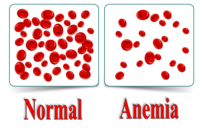 Wellness Lab Health Info: What Is Anemia?