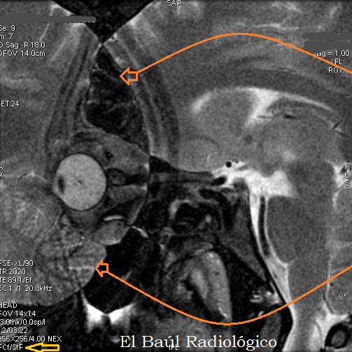 El Baúl Radiológico: ARTEFACTOS POR SUPERPOSICIÓN EN EL SENTIDO DE LA ...