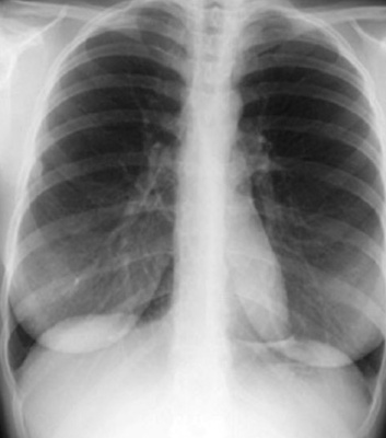 Dr. Lee Breast augmentation Korea: Breast augmentation implants. Chest ...