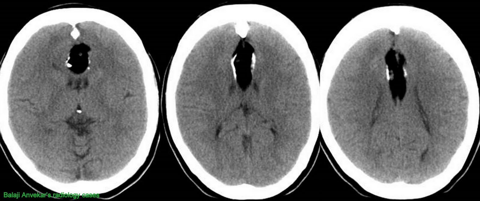 Dr Balaji Anvekar's Neuroradiology Cases: Corpus callosal Agenesis with ...