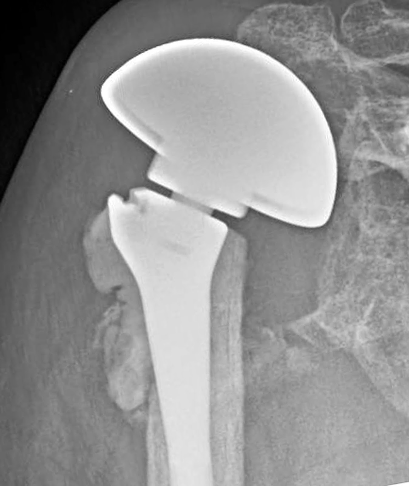 UW Shoulder and Elbow Academy: Reverse total shoulder joint replacement ...
