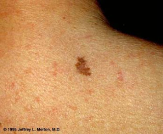 Radioactivity & Skin Cancer: Skin Cancer & Ultraviolet Radiation