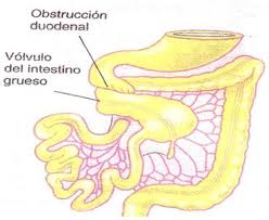 TECNICAS DE PEDIATRIA: ATRESIA Y MALFORMACIONES INTESTINALES