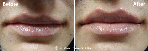 Selston Cosmetic Clinic: Lip Augmentation at Reputable Clinics ...
