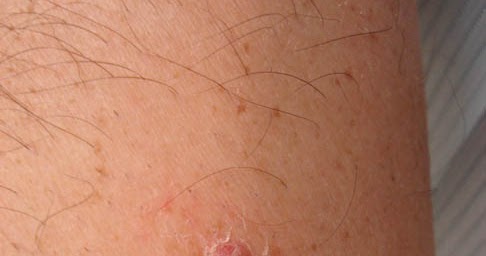 VIRTUAL GRAND ROUNDS IN DERMATOLOGY 2.0: Unusual Tumor in a 53 yo Man