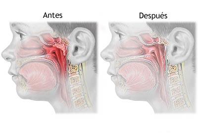 ENFERMERÍA A UN CLIC : ADENOIDITIS