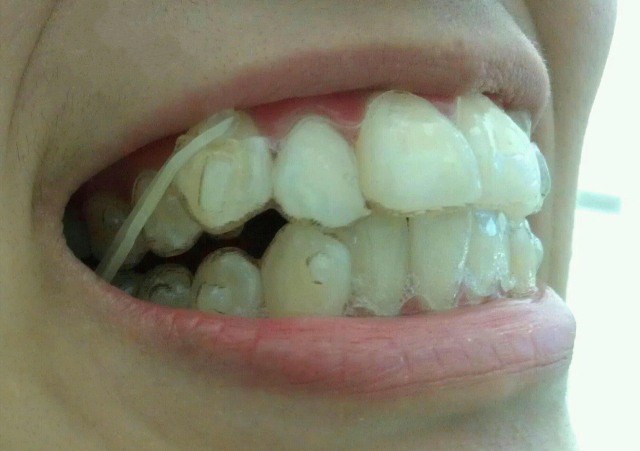 To a better smile - Invisalign!: Stretchy elastics and aligner #3!