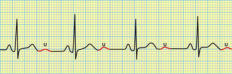 Enciclopédia de ECG - Nomenclatura: Onda U