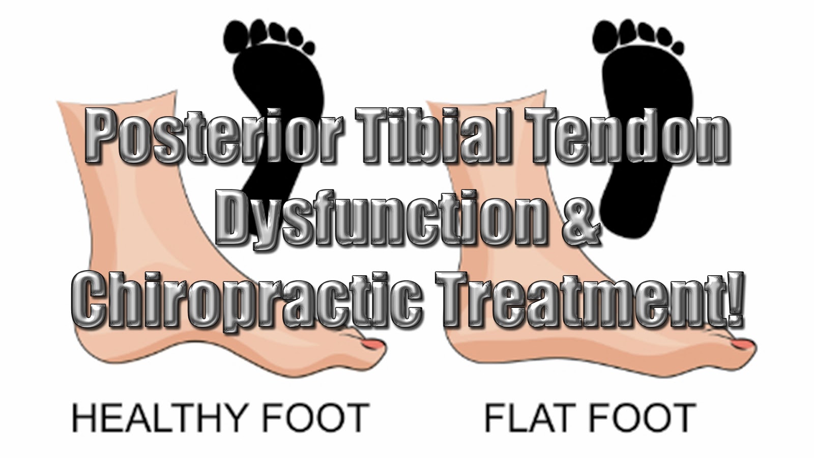 Posterior Tibial Tendon Dysfunction And Chiropractic