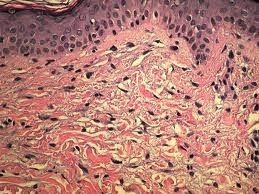 Medical Treatment Pictures-for Better Understanding: Lichen Myxedematosus