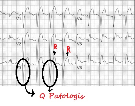 JANTUNG KITA SEHAT: Begini Cara Membaca Old Miokard Infark (OMI) Pada ...