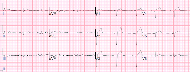 Dr. Smith's ECG Blog: Anterior STEMI and multiform PVCs with Narrow ...