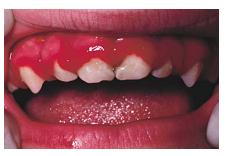 PDQ ORAL DISEASE: Herpetic Stomatitis: Primary