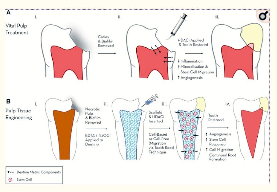 Epigenetic Approaches to the Treatment of Dental Pulp Inflammation and ...